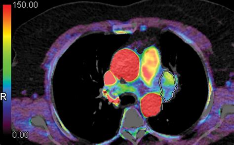 Value Of Whole Tumor Dual Input Perfusion Ct In Predicting The Effect Of Multiarterial Infusion