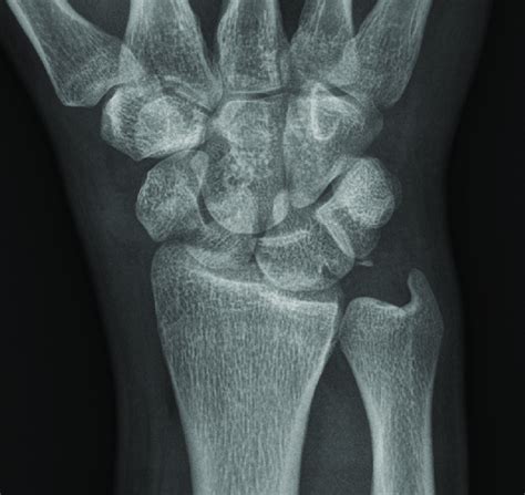 Posteroanterior Radiograph Of A Dorsal Perilunate Fracture Dislocation Download Scientific