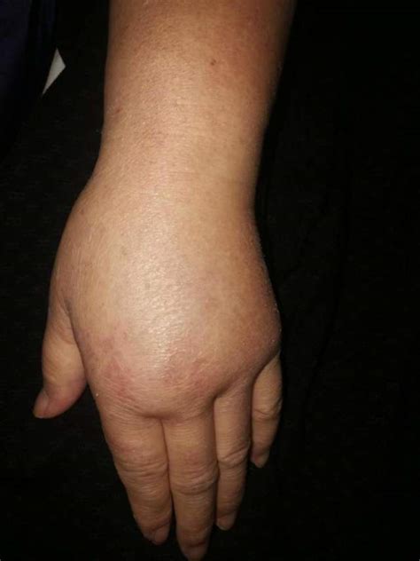 中山医院皮肤科发现一种特殊类型的皮肌炎！出现这些症状要警惕腾讯新闻