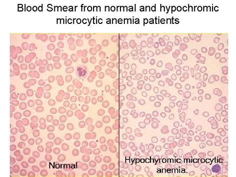 Blood Erythrocytes Rbc Blood Smear With Erythrocytes Red