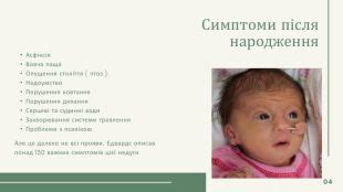 Презентація Синдром Едвардса