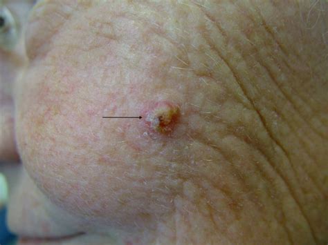 Actinic Keratosis Solar Keratosis