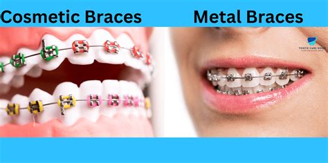 What Are Cosmetic Braces And Their Function A Guide
