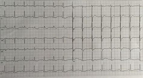 Electrocardiogram After Radiofrequency Ablation Download Scientific