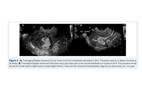Uterine Arteriovenous Malformation Acquired Dr Mamta Lekhi Ppt Pregnancy Reproductive Health