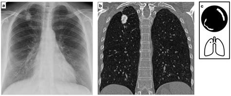 Calcified Lung Nodules A Diagnostic Challenge In Clinical Daily