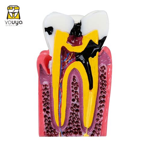 6 Times Dental Model Molar Pathological Anatomic C Vicedeal
