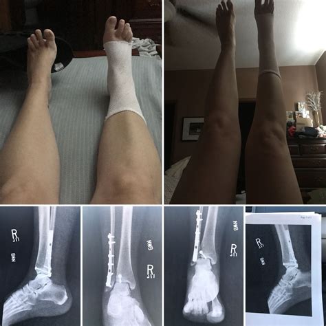 Broken Tibia Fibula Progress Update Xray And Stretches Artofit