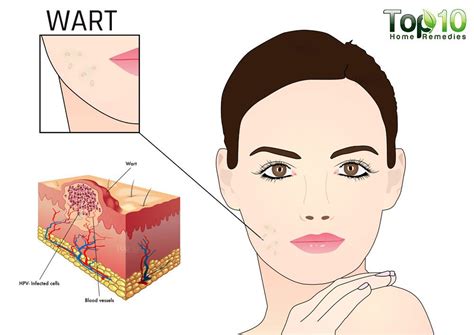 How To Remove Lip Wart At Randall Starkes Blog