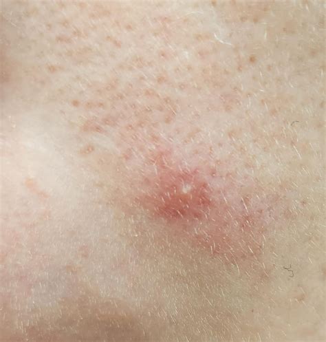 Small Itchy Red Bump Acne Rdermatologyquestions