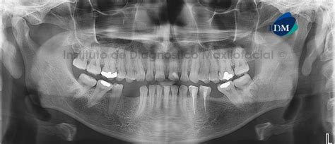 100 Osteosarcoma Mandibular Idm
