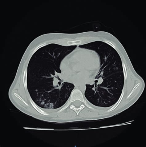 Small Nodular Infiltration Of The Lower Lung Bases Pronounced Within Download Scientific