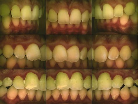 Top Mild Gingivitis With Early Signs Of Erythema And Blunting Of Download Scientific Diagram