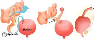 The Role Of Imaging In Pediatric Bladder Augmentation Springerlink