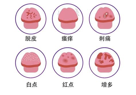 丁丁发炎 盯上”你？是怎么引起的！龟头进行包皮