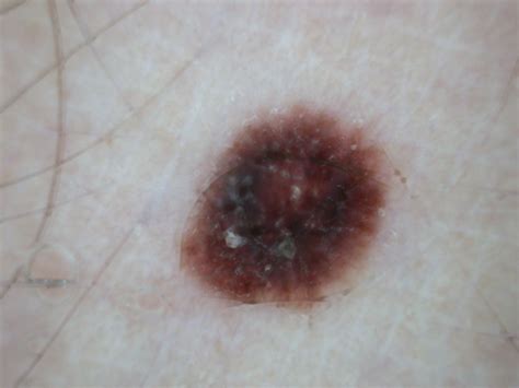 Github Aybilgemurat Imagecleaningforskincanceropencv Image Cleaning For Skin Cancer Diagnosis
