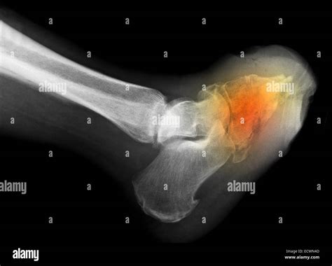 Osteomyelitis X Rays