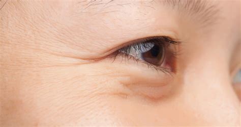 Best Profhilo Face Treatment Enhance Your Natural Beauty Best