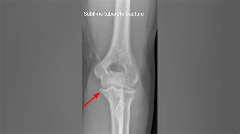 Sublime Tubercle Fracture Xray Youtube