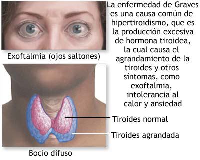 Panamericano De Ojos ¿afectan Los Desordenes De Tiroides A Nuestros Ojos