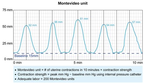 Mvu Uterine Contractions In 10 Minutes X Contraction