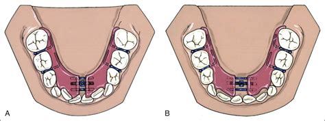 Maxillary Deficiency Syndrome Pocket Dentistry