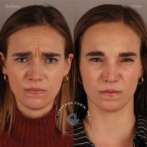 Botox Cabinmd Facial Plastics And Aesthetics