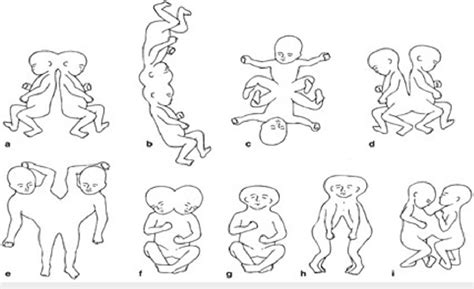 Classification Of Conjoined Twins A Craniopagus Occipital Fusion