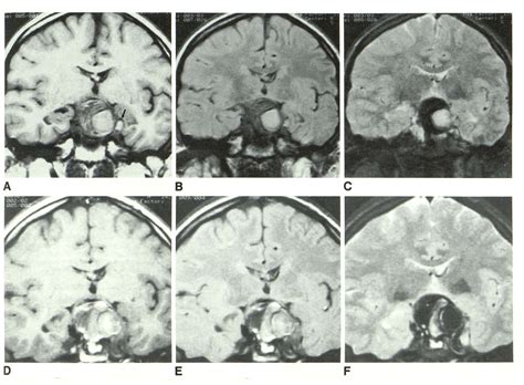 Figure 1 From Thrombus Formation And Structure And The Evolution Of