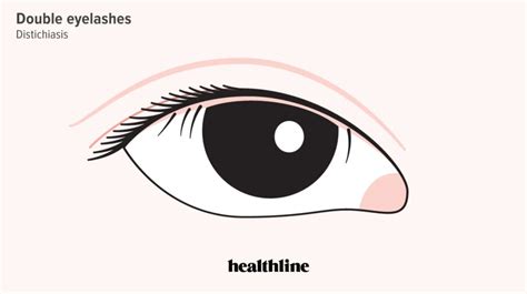 Double Eyelashes Distichiasis Causes And Treatment