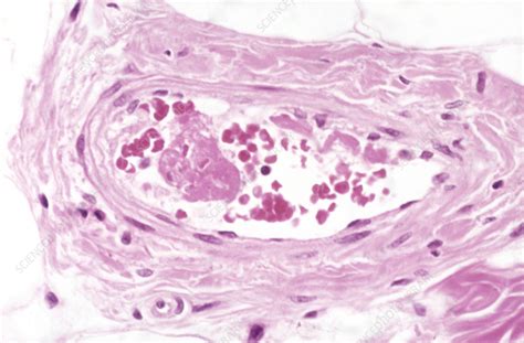 Meningococcal Septicaemia Light Micrograph Stock Image C0556484