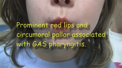 Strep Throat And Scarlet Fever Youtube