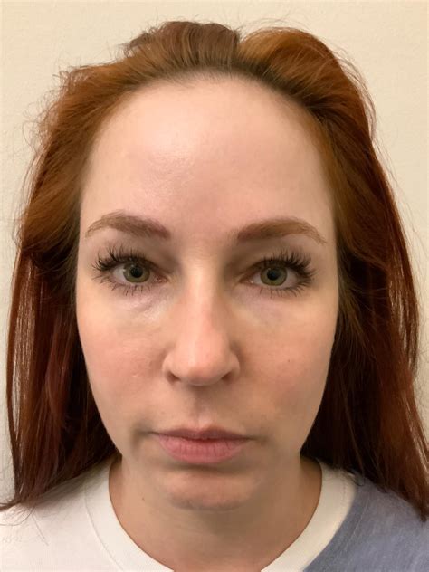 Before And After Libbie Wallace Skin Clinic