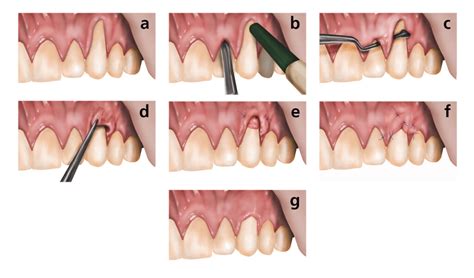 Periodontal Surgery Leeds Teaching Hospitals Nhs Trust
