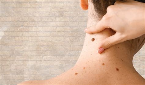 Seborrheic Keratosis Causes Symptoms And Treatment Options