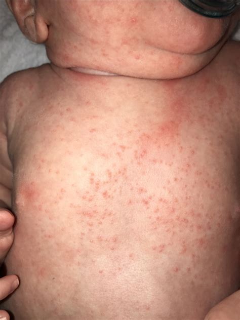 Erythema Toxicum Rash Glow Community