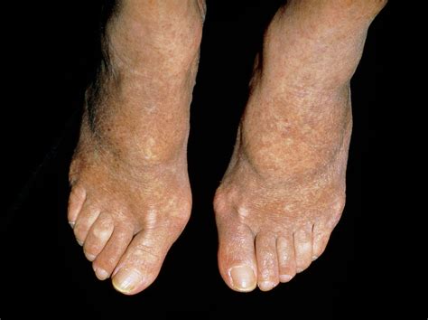 Vascular Disease Legs Pictures Frequently Asked Questions About