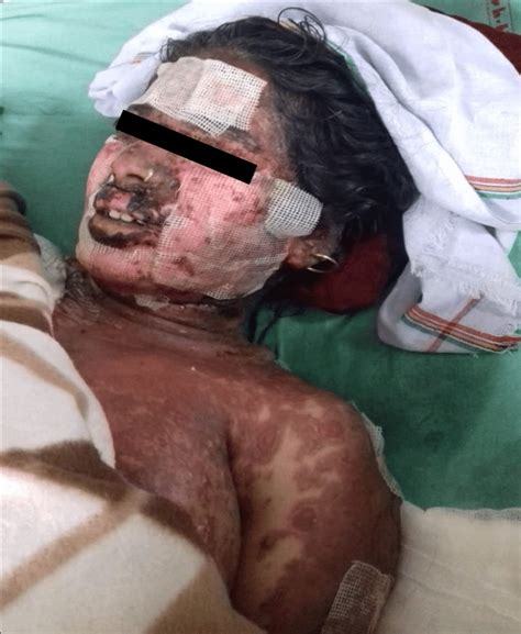 Morbilliform Eruptions All Over The Body Download Scientific Diagram