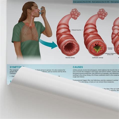 The Anatomy Of Asthma Chart Poster Anatomystuff