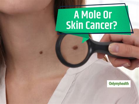 Skin Cancer Vs Mole Differences And When To Seek Help Bkzpko