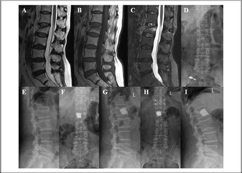 The Imaging Data Of A 70 Year Old Woman Showed L2 Vertebral Compression