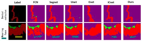 Micromachines Free Full Text Dental Lesion Segmentation Using An Improved Icnet Network With