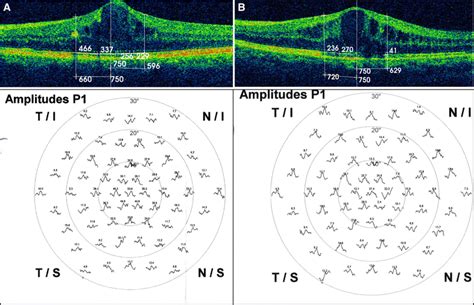A Eye Number 5 Of The Study Showed An Ellipsoid Zone Preservation Rate