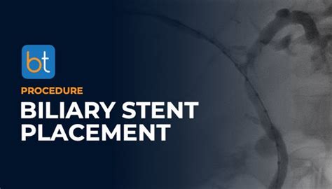 Biliary Stent Placement Procedure Backtable Vi