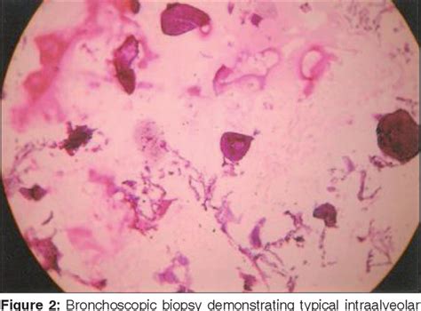 Figure 2 From Pulmonary Alveolar Microlithiasis With Calcified Pleural