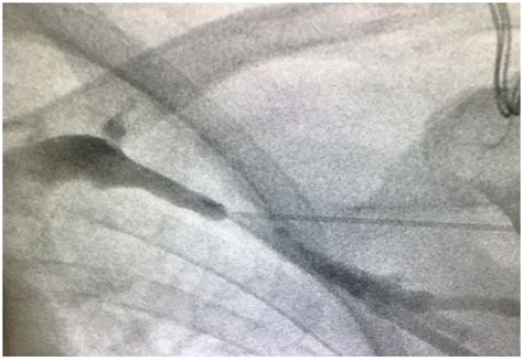 Venogram Of The Axillary Vein The Needle Can Be Seen Indenting And