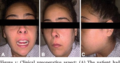 Figure 1 From Deep Neck Space Infections An Odontogenic Parapharyngeal
