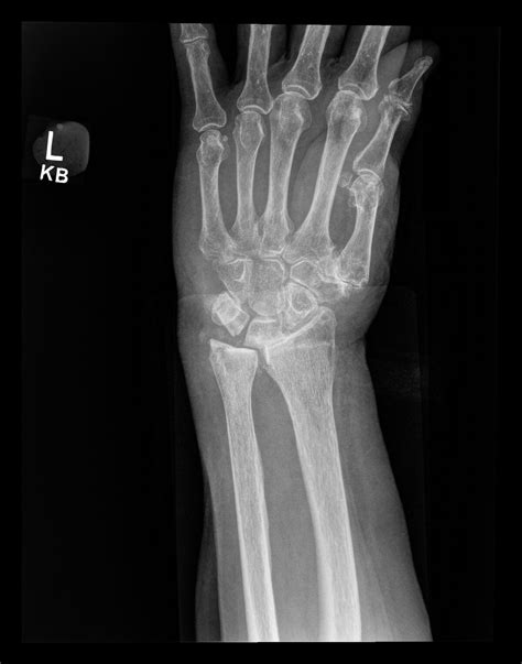 Radiopaedia Case Distal Radius Fracture Background Cppd Id 93797