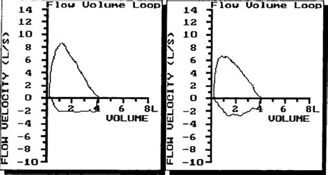 Abnormal Flow Volume Curves On Repeated Trials During A Symptomatic