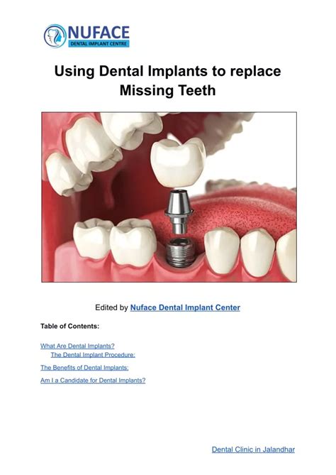 Ppt Using Dental Implants To Replace Missing Teeth Powerpoint Presentation Id12018863